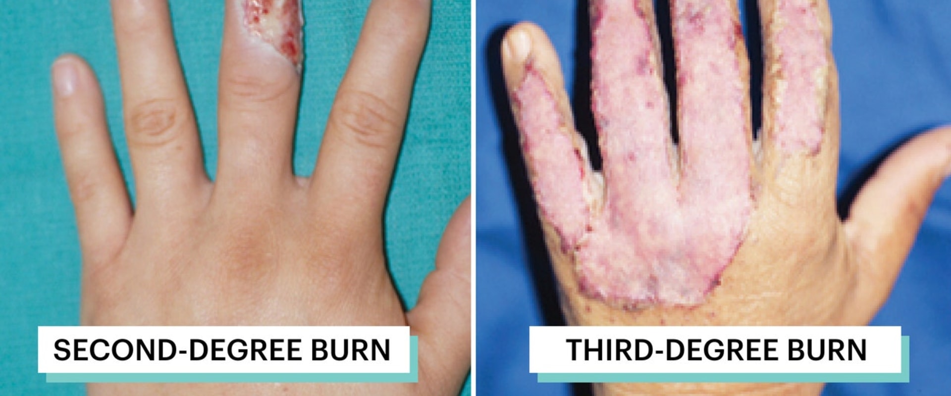 The Ultimate Guide to 2nd Degree Burn Healing Stages